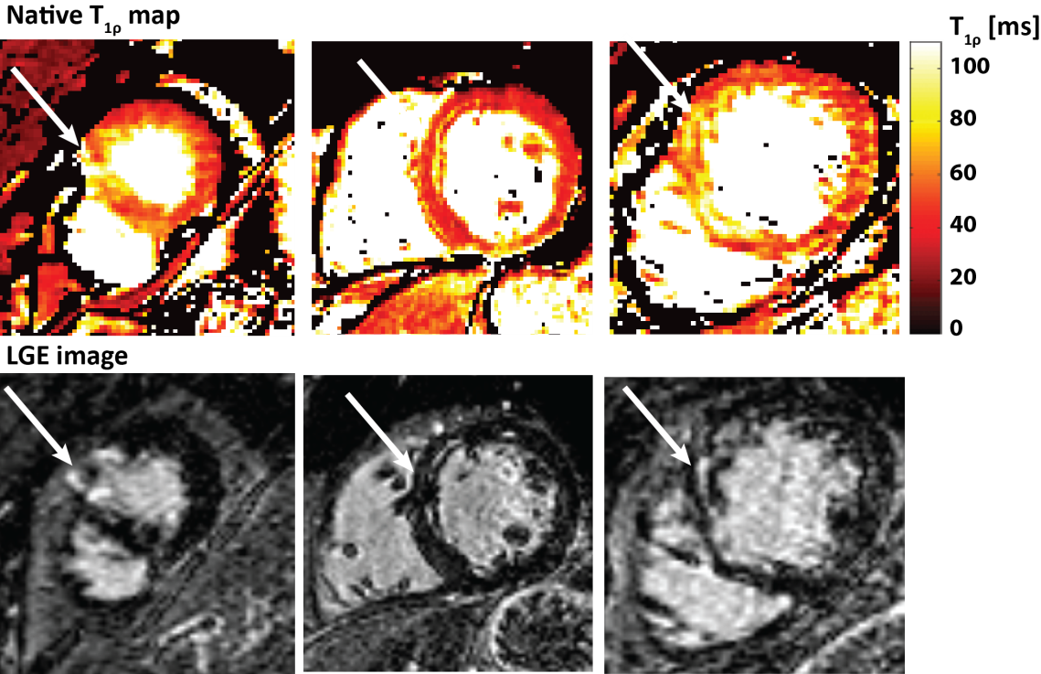 Myocardial Fibrosis Detection Without A Contrast Agent Umc Utrecht