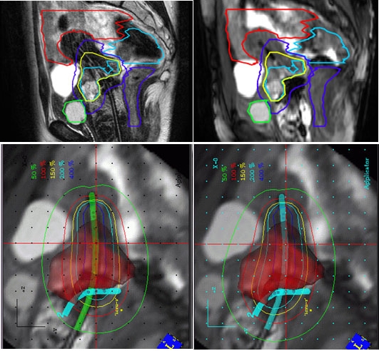 Cervix Cancer - UMC Utrecht